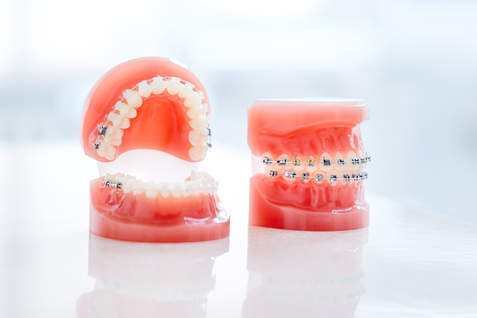 The History of Braces | Simply Orthodontics of Worcester